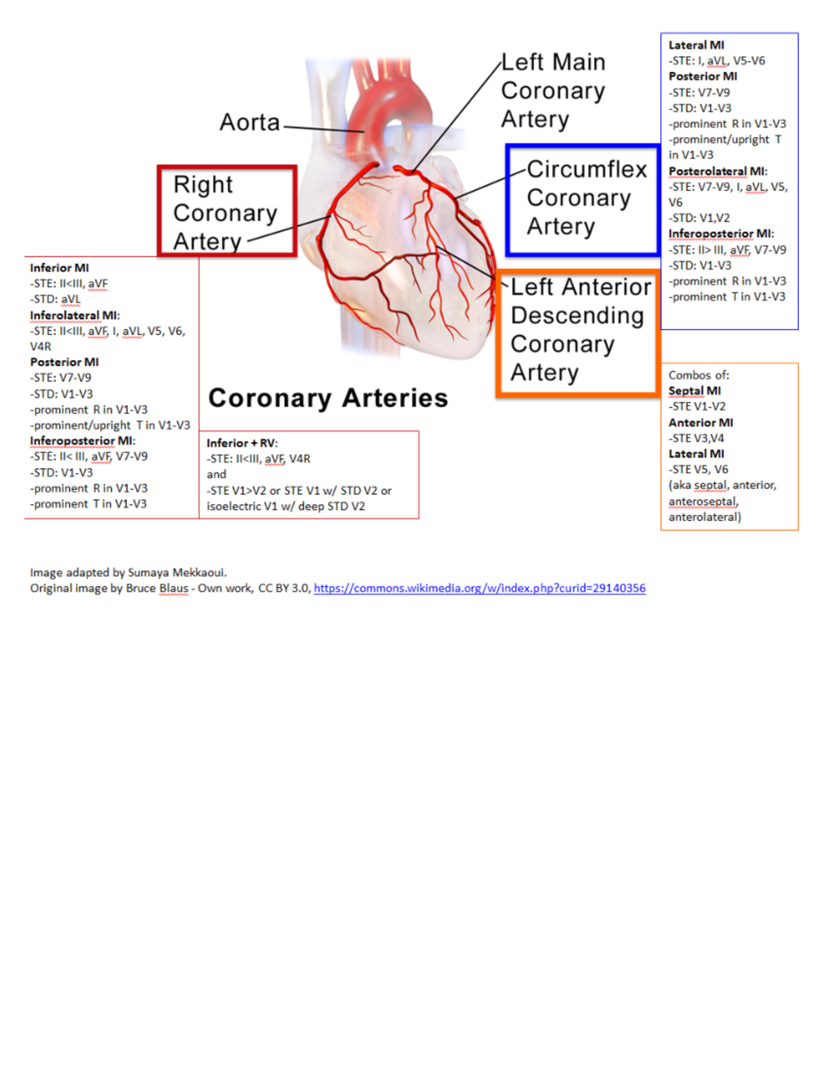 Diagrams - Coronary STEMI, myocardial infarction and EKG - Lateral MI ...