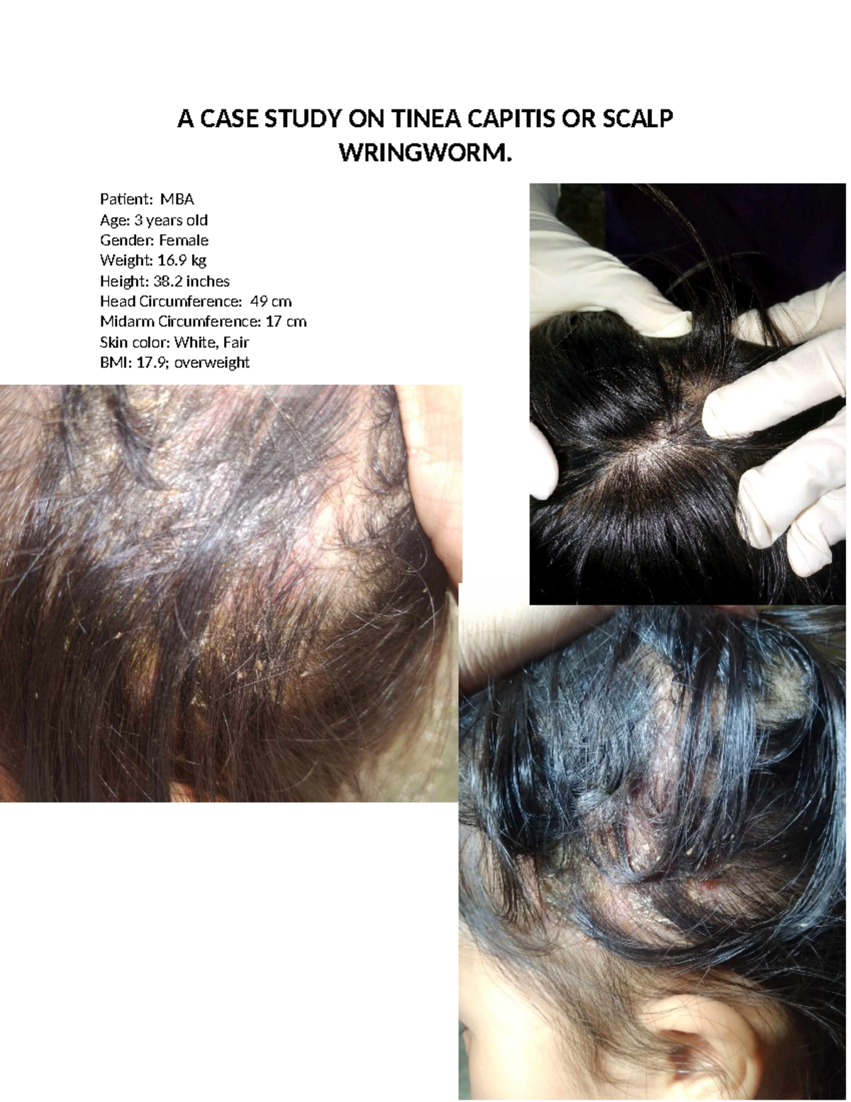 A CASE Study ON Tinea Capitis - A CASE STUDY ON TINEA CAPITIS OR SCALP ...