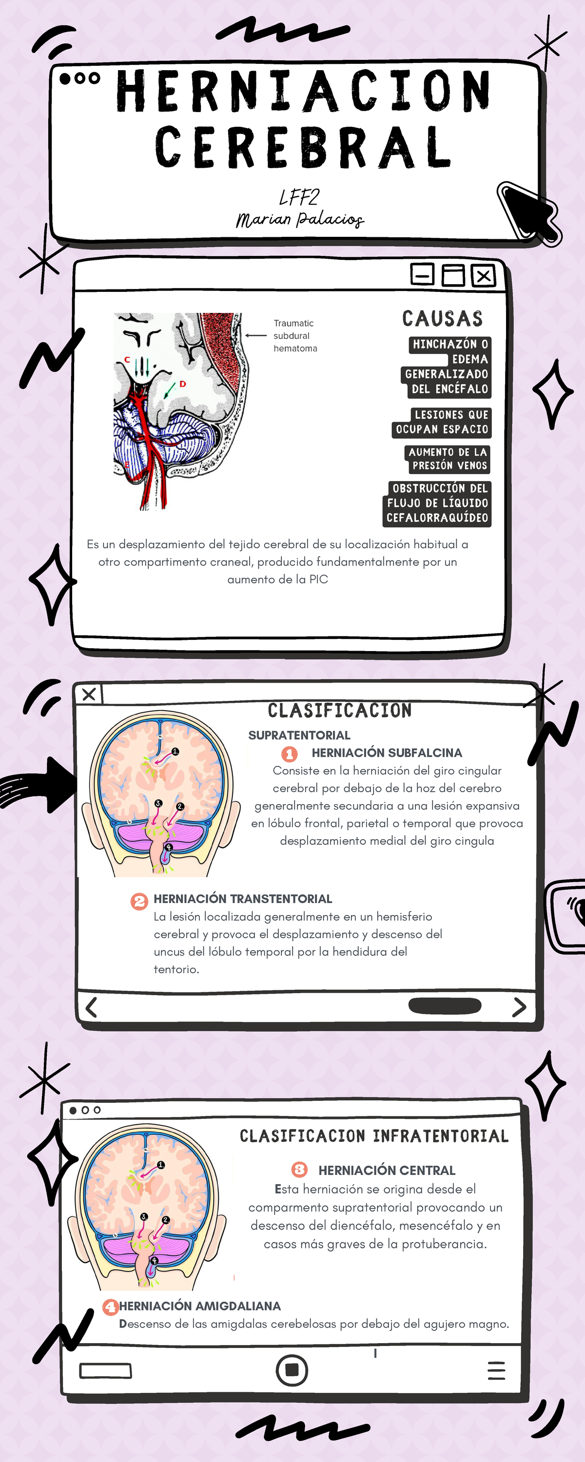 Herniaciones Cerebrales - ####### CLASIFICACION INFRATENTORIAL ...