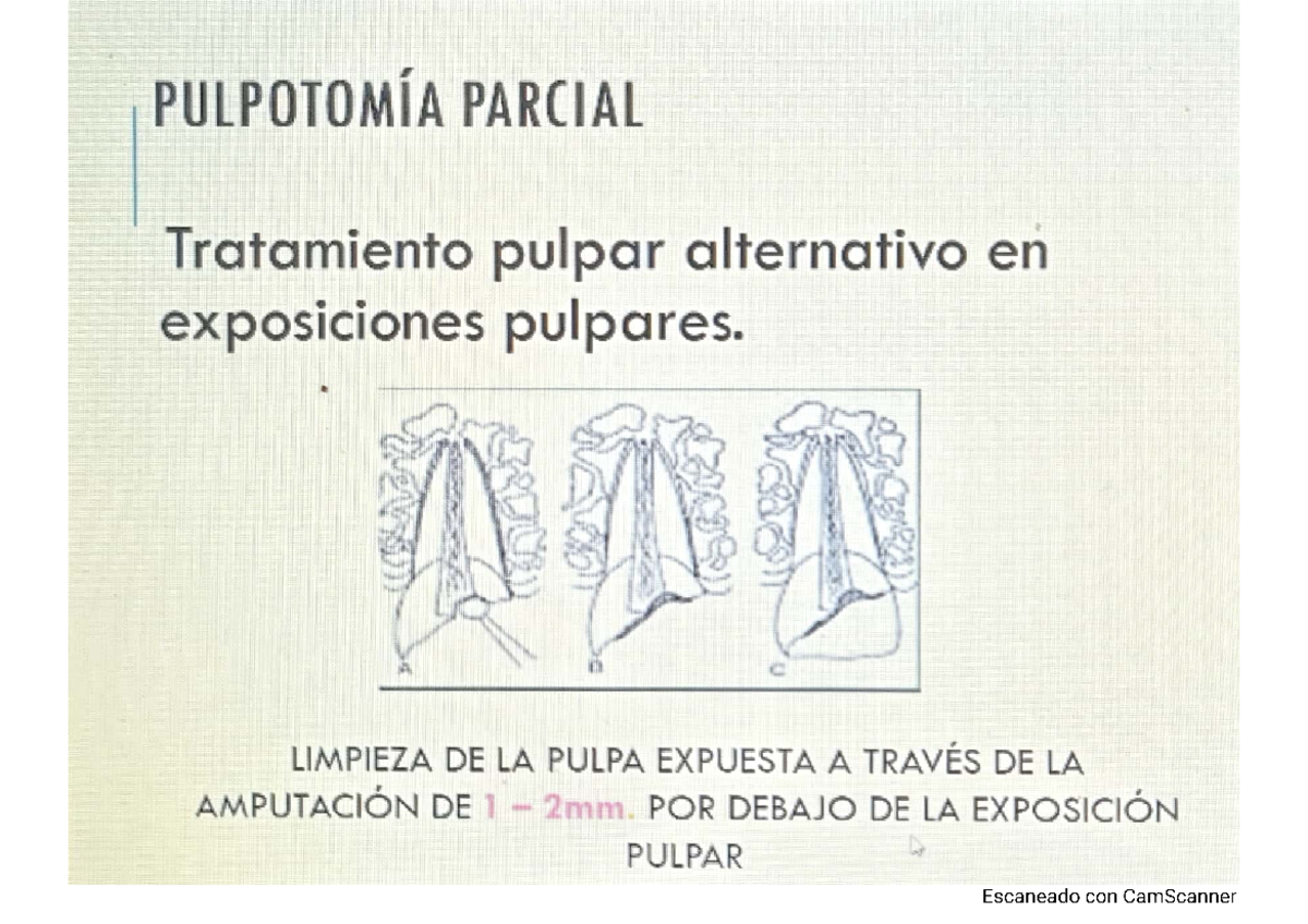 Pulpotomia pedía - PULPOTOMÍA PARCIAL Tratamiento pulpar alternativo en ...