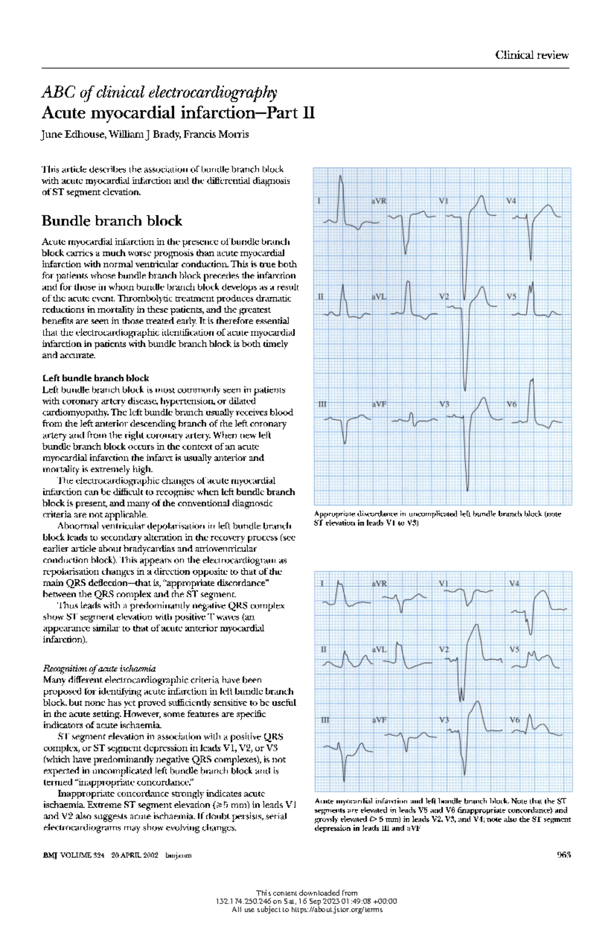 ABC Of Clinical Electrocardiography Acute Myocardial Infarction Part II ...