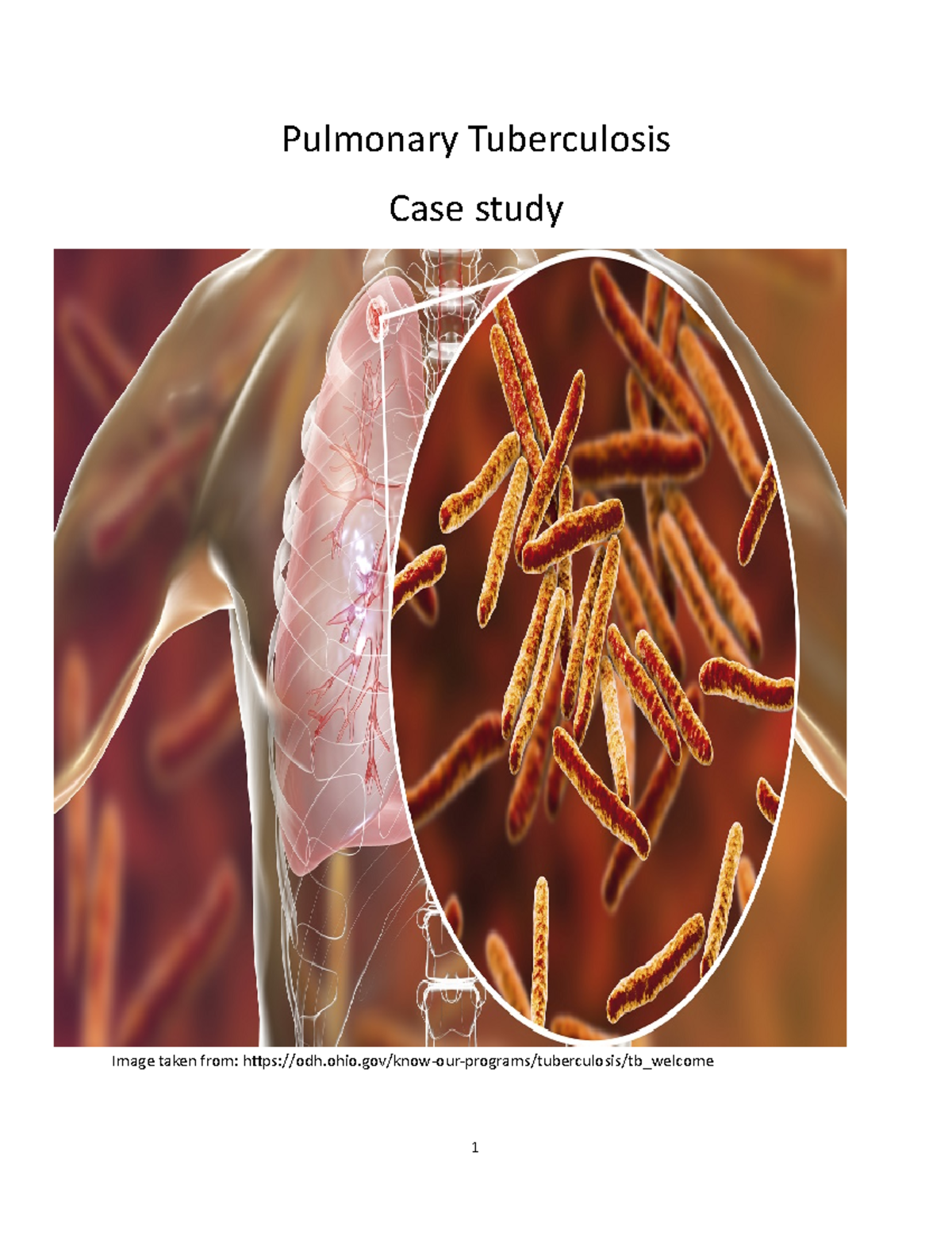 Mam file - psychology students note - Pulmonary Tuberculosis Case study ...