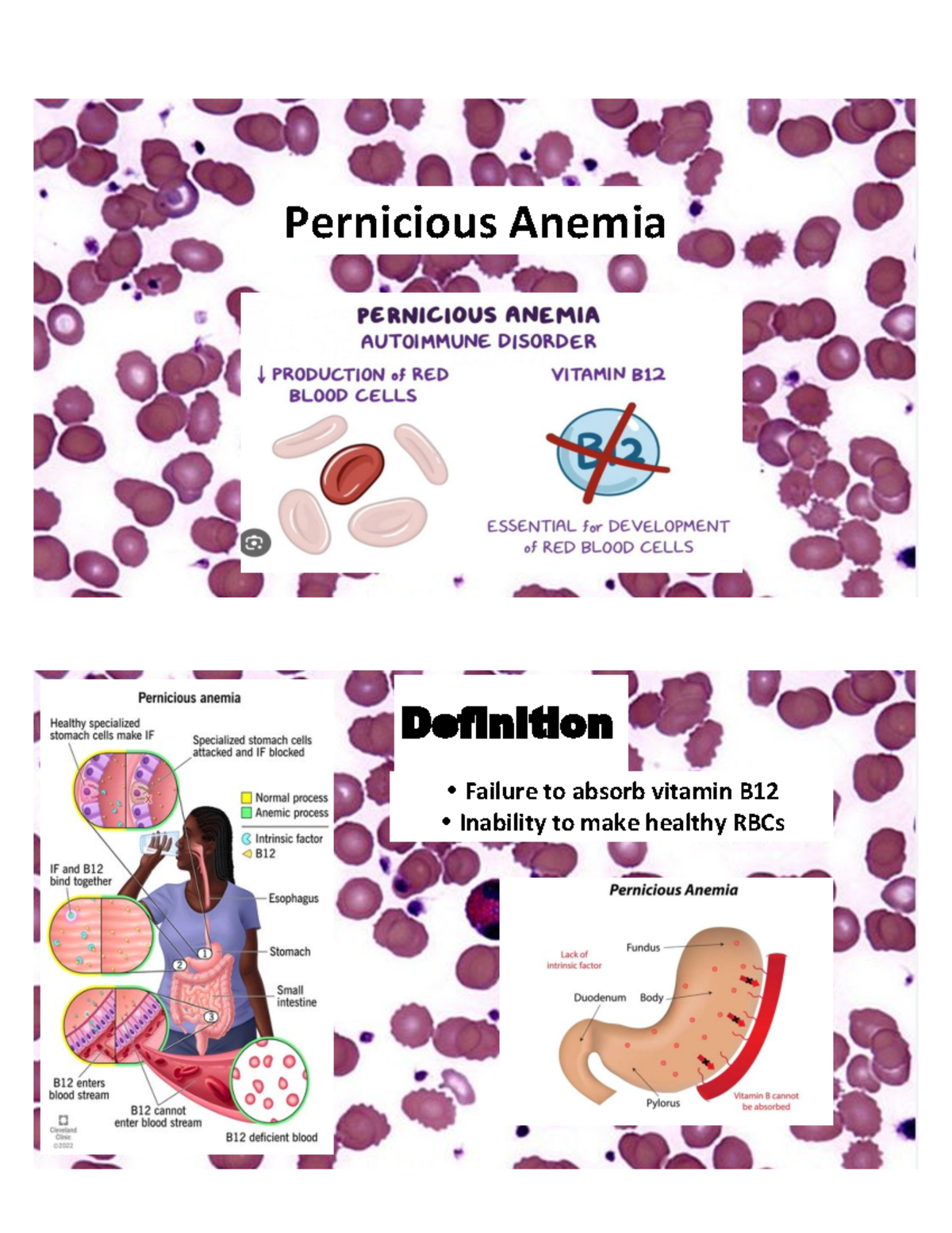 NSG+2522+Gastric+Disorders - Pernicious Anemia Definition • Failure to ...