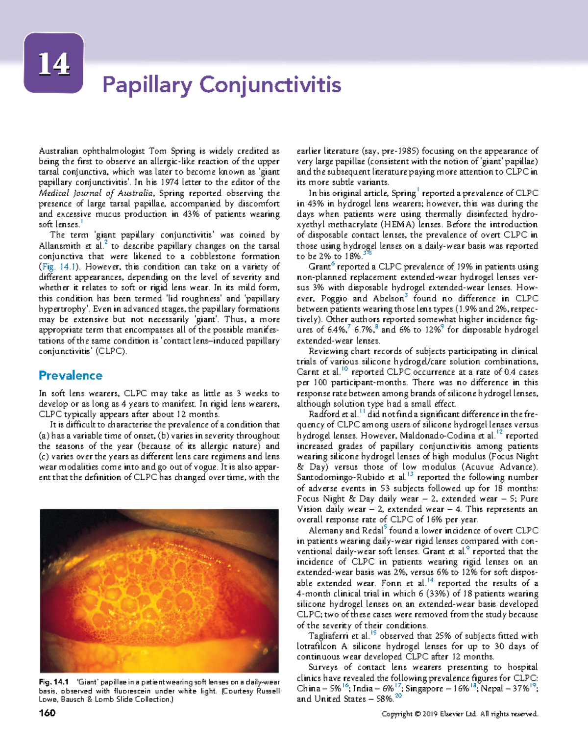 Papillary Conjunctivitis Contact Lens Complications - 1414 Papillary ...