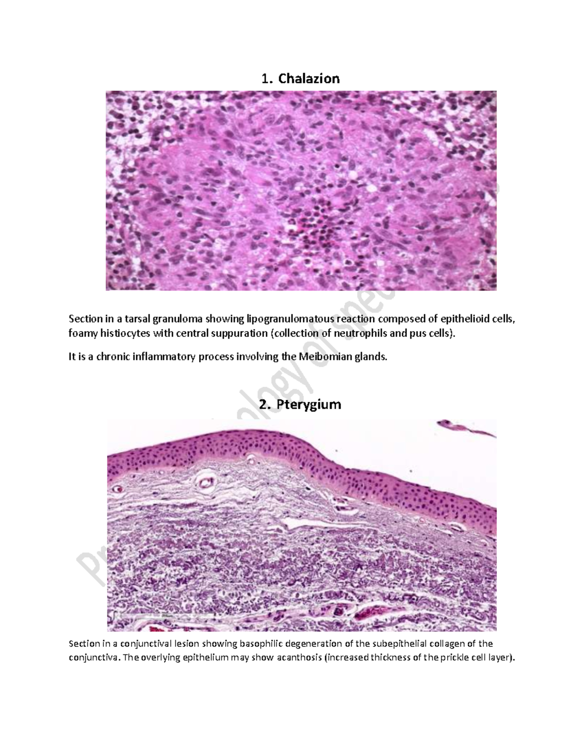 Practical Pathology of special senses - 1. Chalazion Section in a ...