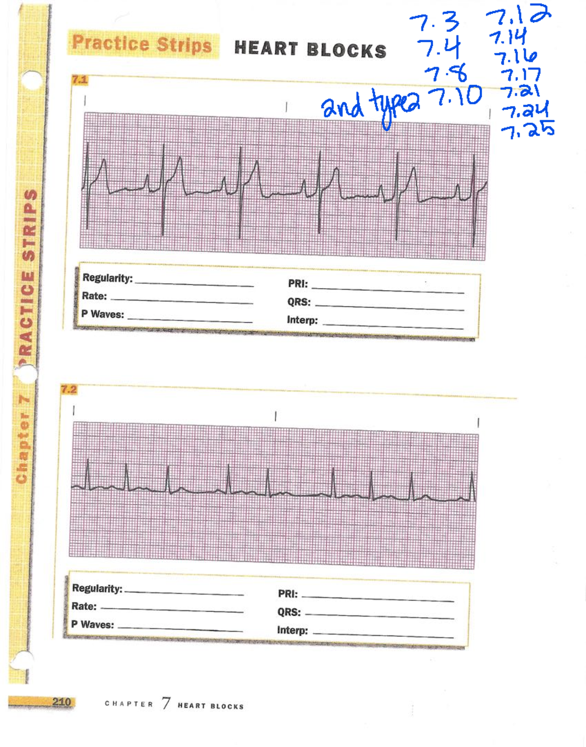 Heart Block EKG Strips - complex - RNSG 1309 - Studocu