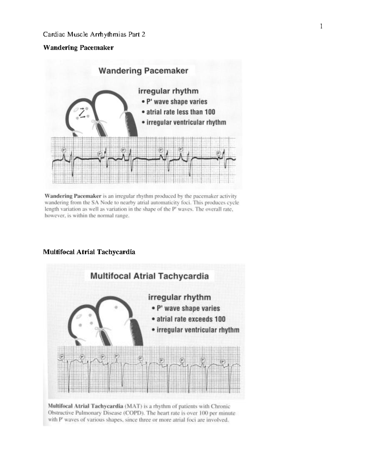 17Cardiac Arrhythmias Part 2 - Cardiac Muscle Arrhythmias Part 2 ...