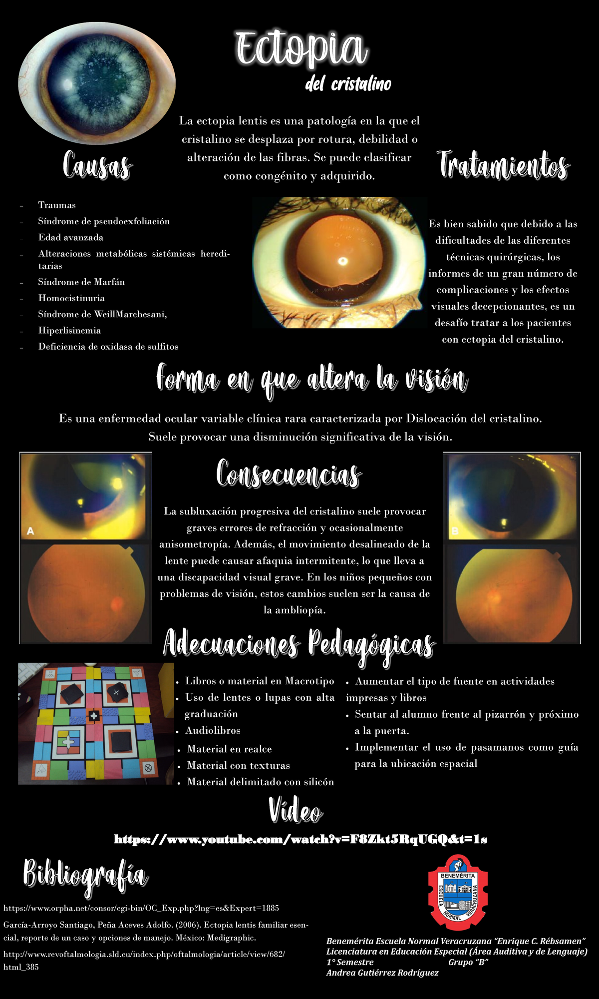 Ectopia del Cristalino - La ectopia lentis es una patología en la que ...