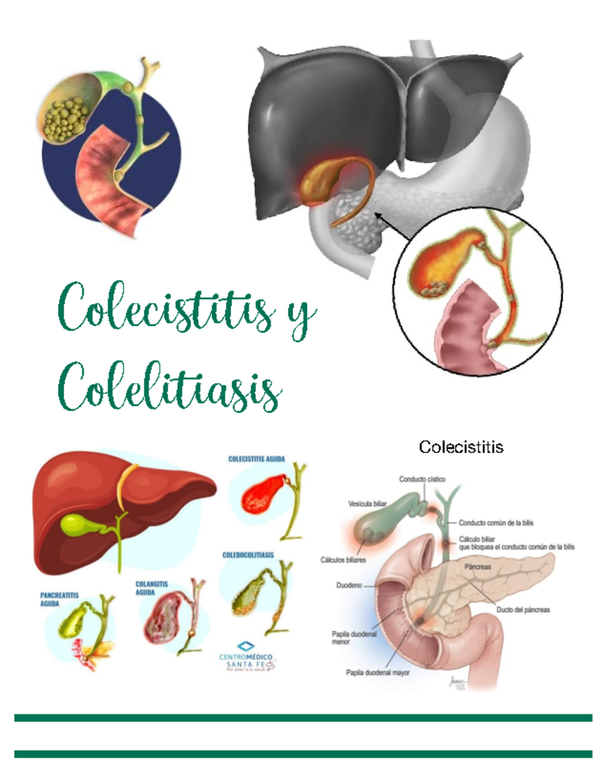Colecistitis Y Colelitiasis Resumen - Colecistitis y Colelitiasis ...