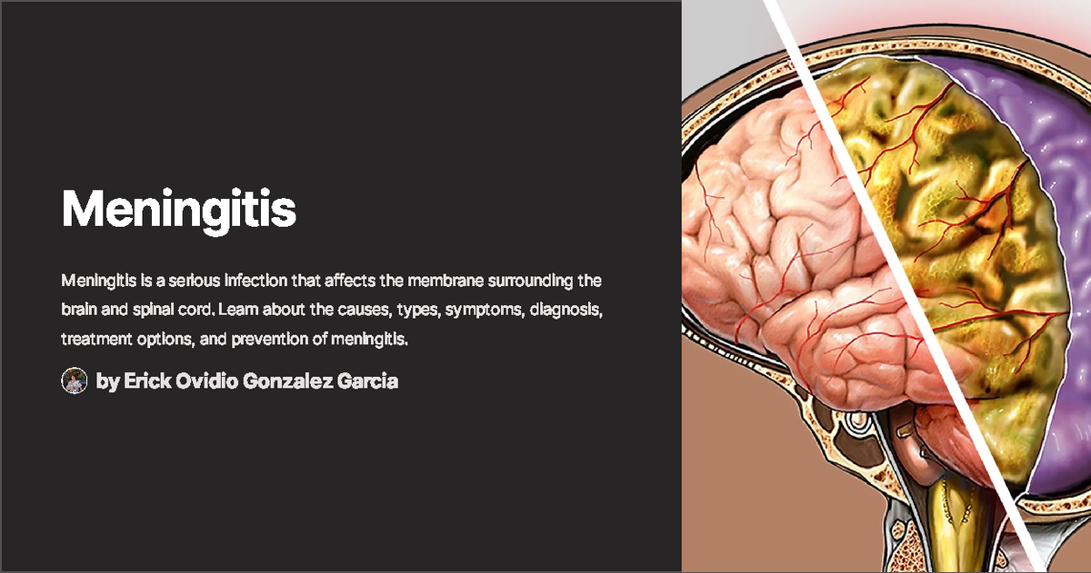 Meningitis - Learn about the causes, types, symptoms, diagnosis ...