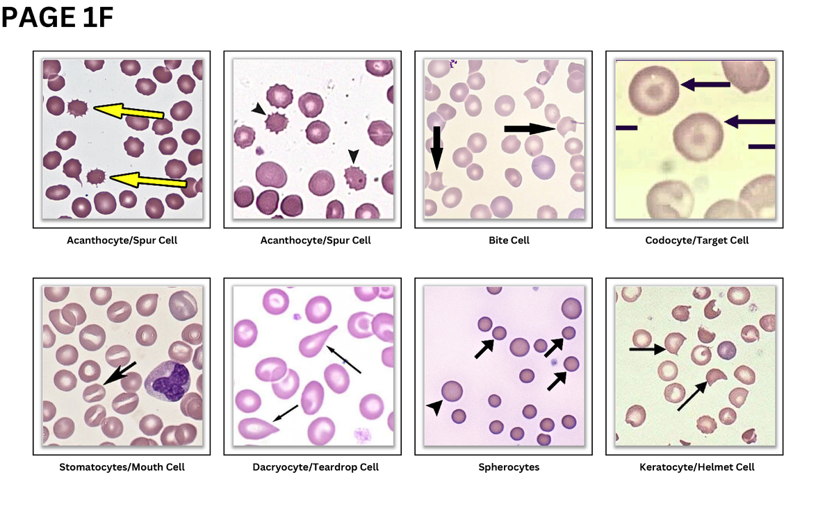 Poikilocytosis RBC Inclusions Flashcards - Acanthocyte/Spur Cell ...