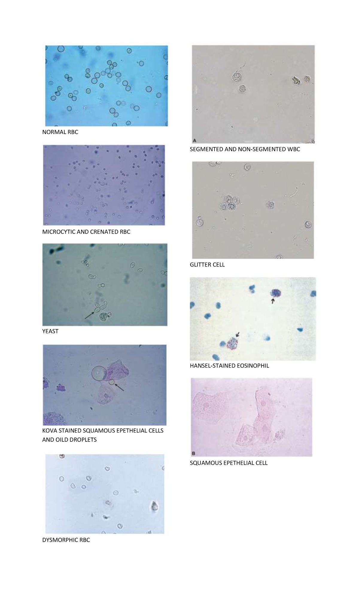 Microscopic Examination - NORMAL RBC MICROCYTIC AND CRENATED RBC YEAST ...