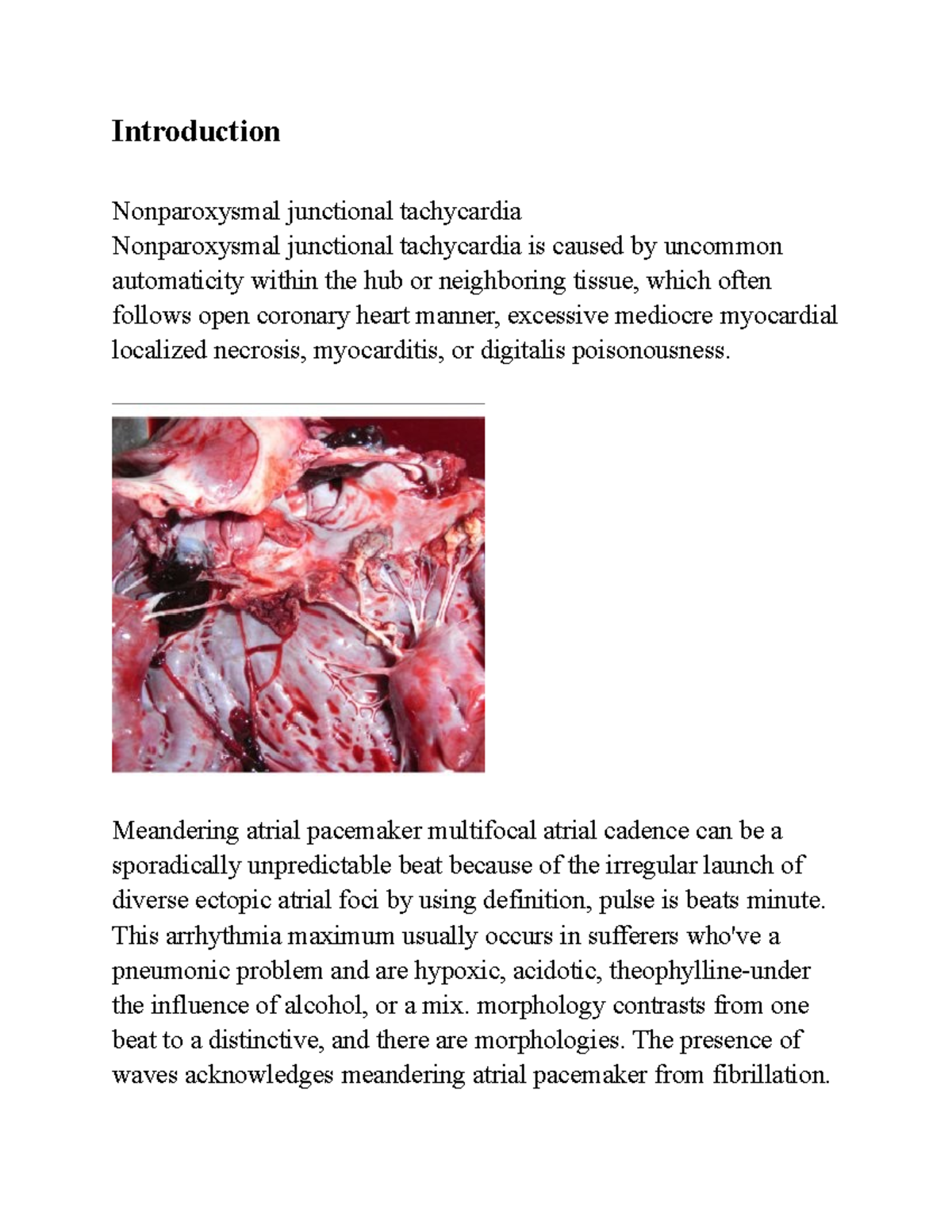 Tachycardia pathology - Introduction Nonparoxysmal junctional ...