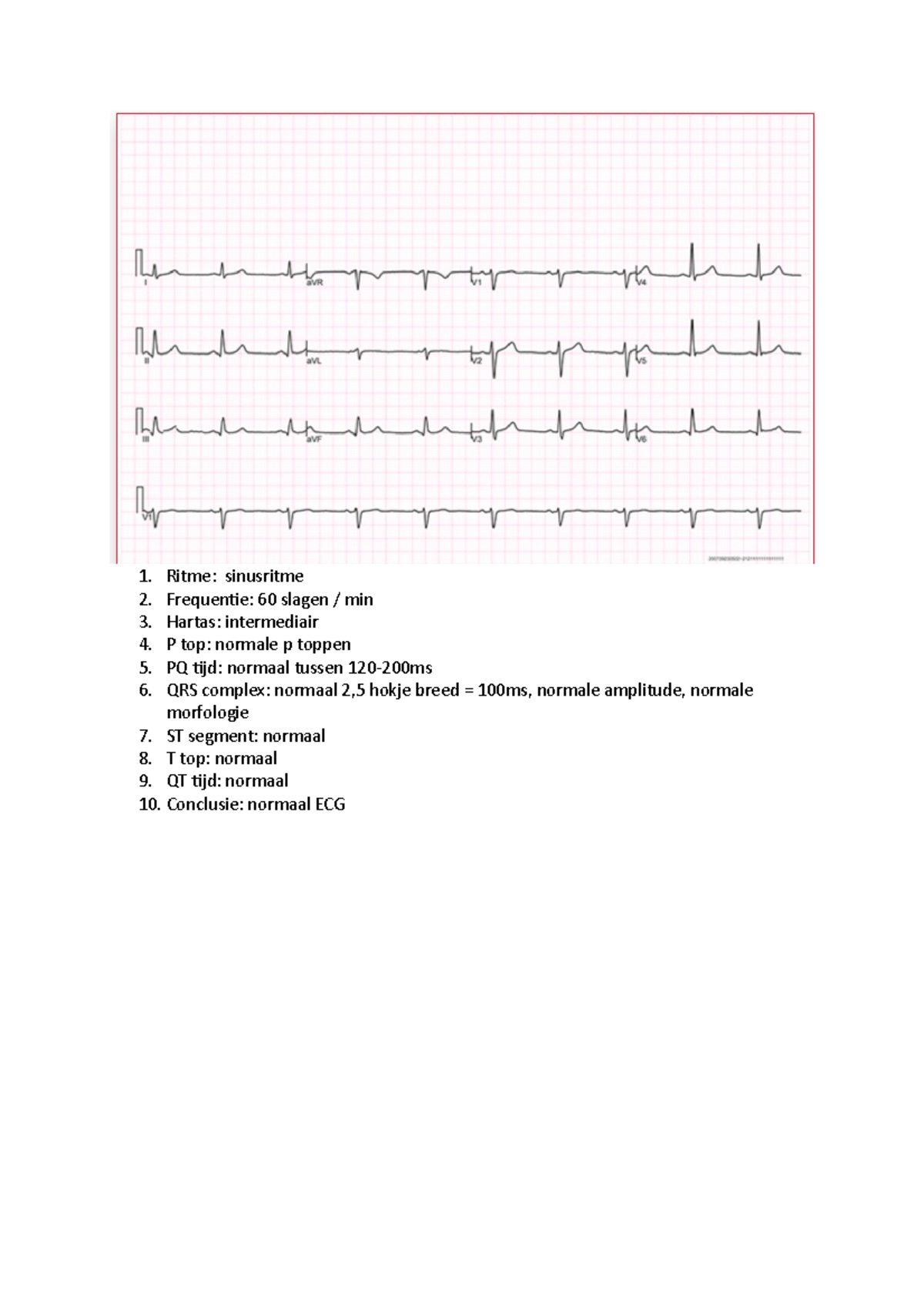 Ecg casus e learning - Ritme: sinusritme Frequentie: 60 slagen / min ...