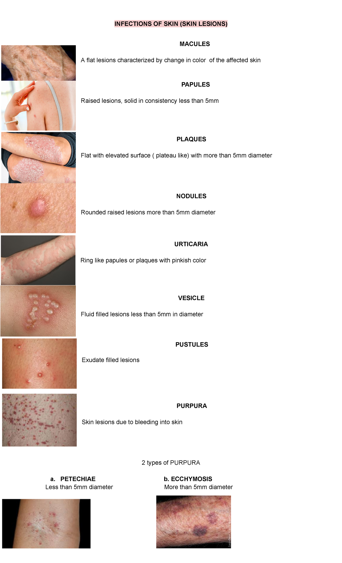 INFECTIONS OF SKIN - PETECHIAE b. ECCHYMOSIS Less than 5mm diameter ...