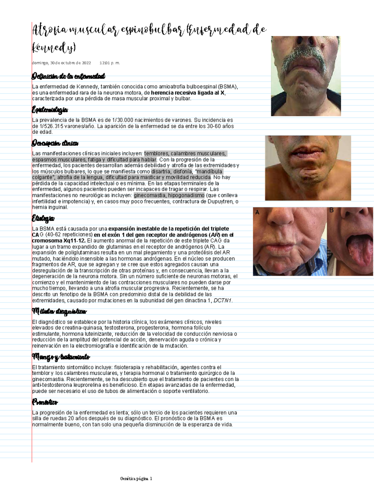 Atrofia muscular espinobulbar (enfermedad de Keneddy) - Definición de ...