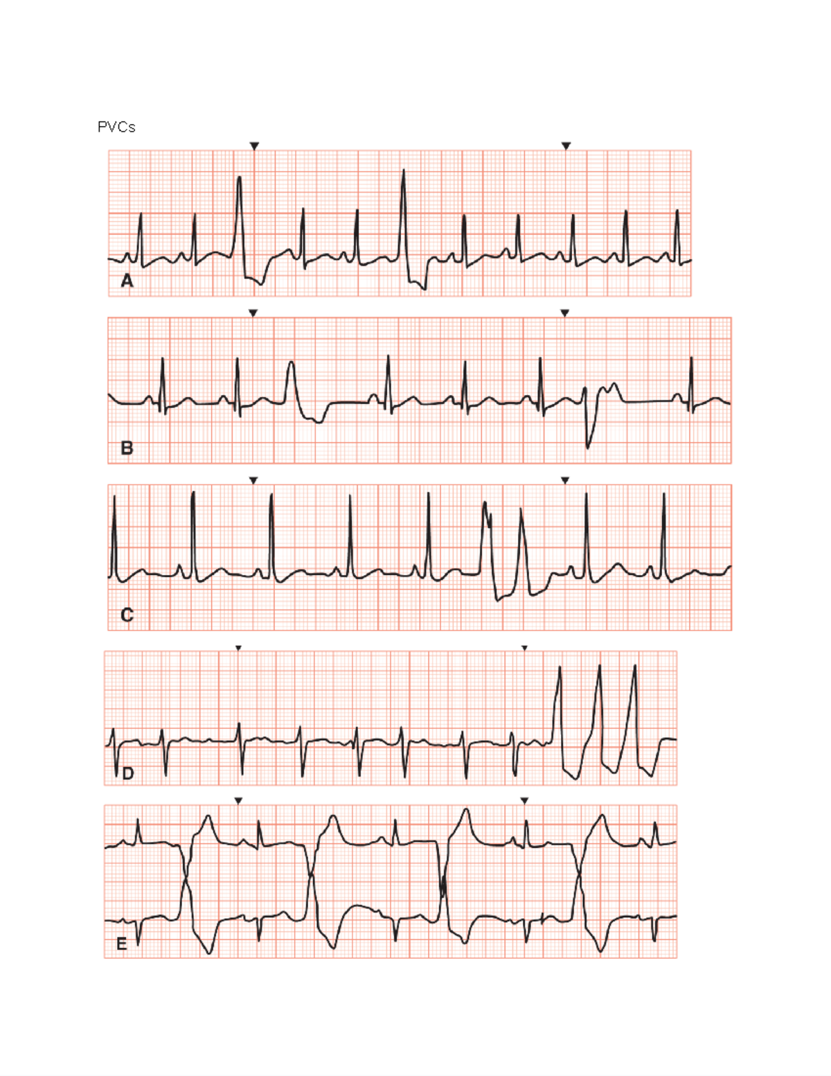 Ekgs 4th sem - ekgs - PVCs Premature ventricular contractions. A ...