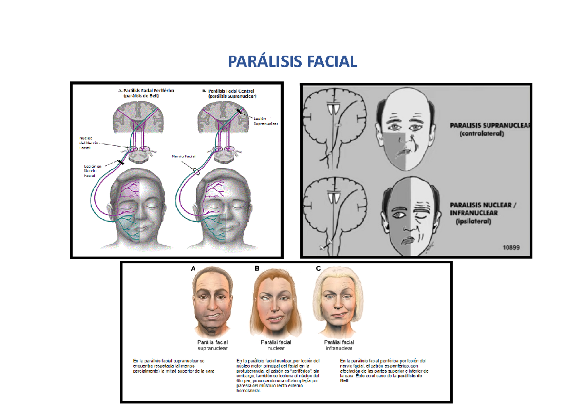 Parálisis facial - PARÁLISIS FACIAL VALORACIÓN DEL GRADO DE PARÁLISIS ...