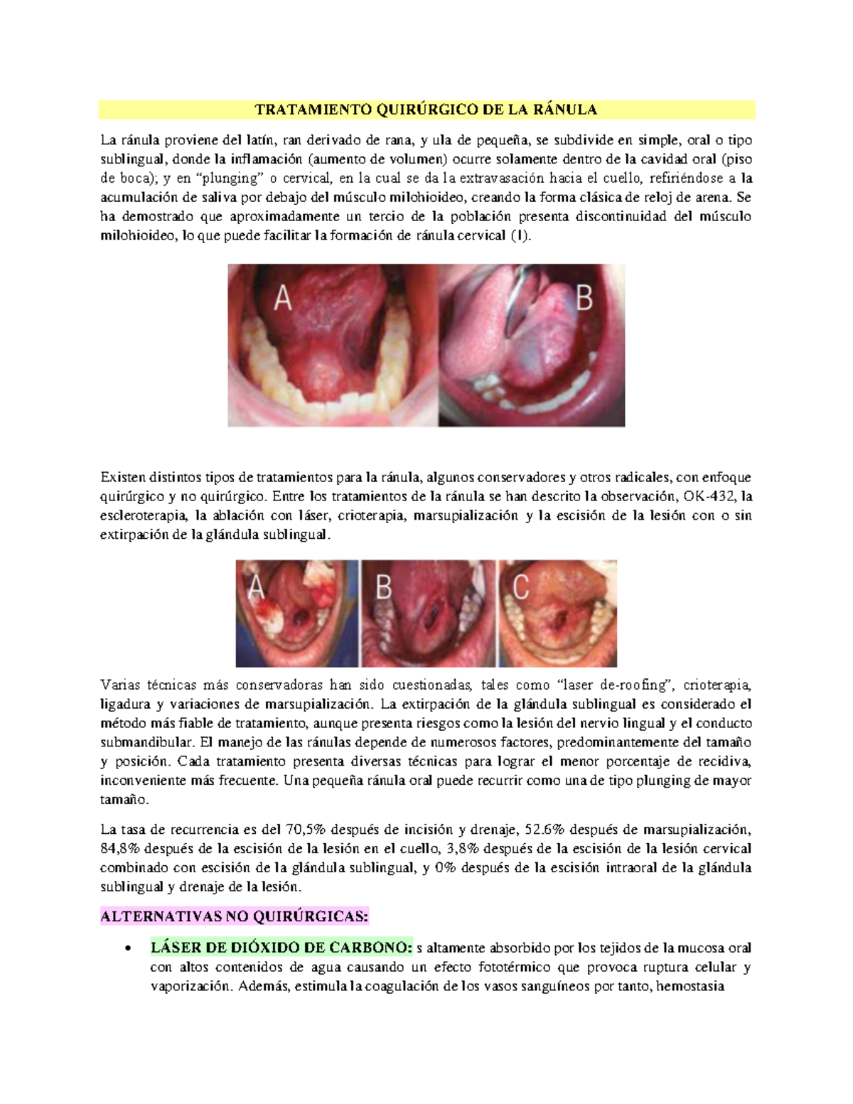 Apuntes investigativos - TRATAMIENTO QUIRÚRGICO DE LA RÁNULA La ránula ...