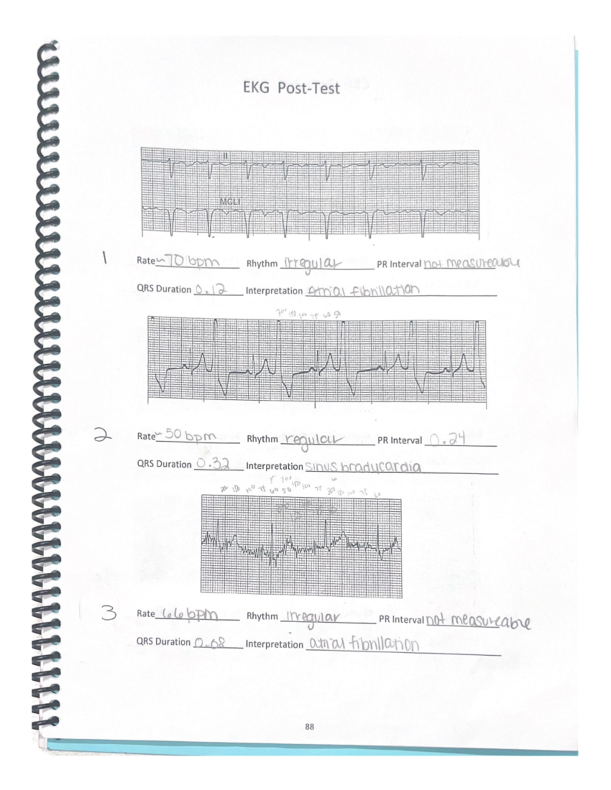 EKG hw - EKG - EKG MCLE Rhythm irregular PR Interval not measureable QRS Duration 0 ...