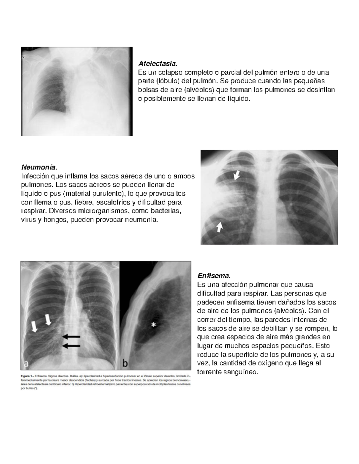 Atelectasia - ... - Atelectasia. Es un colapso completo o parcial del ...