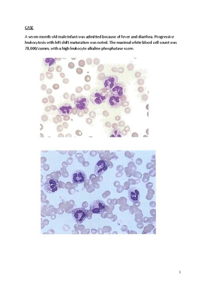 Rinne and Weber's Test with Hearing Loss Patterns - Rinne’s and Weber’s ...