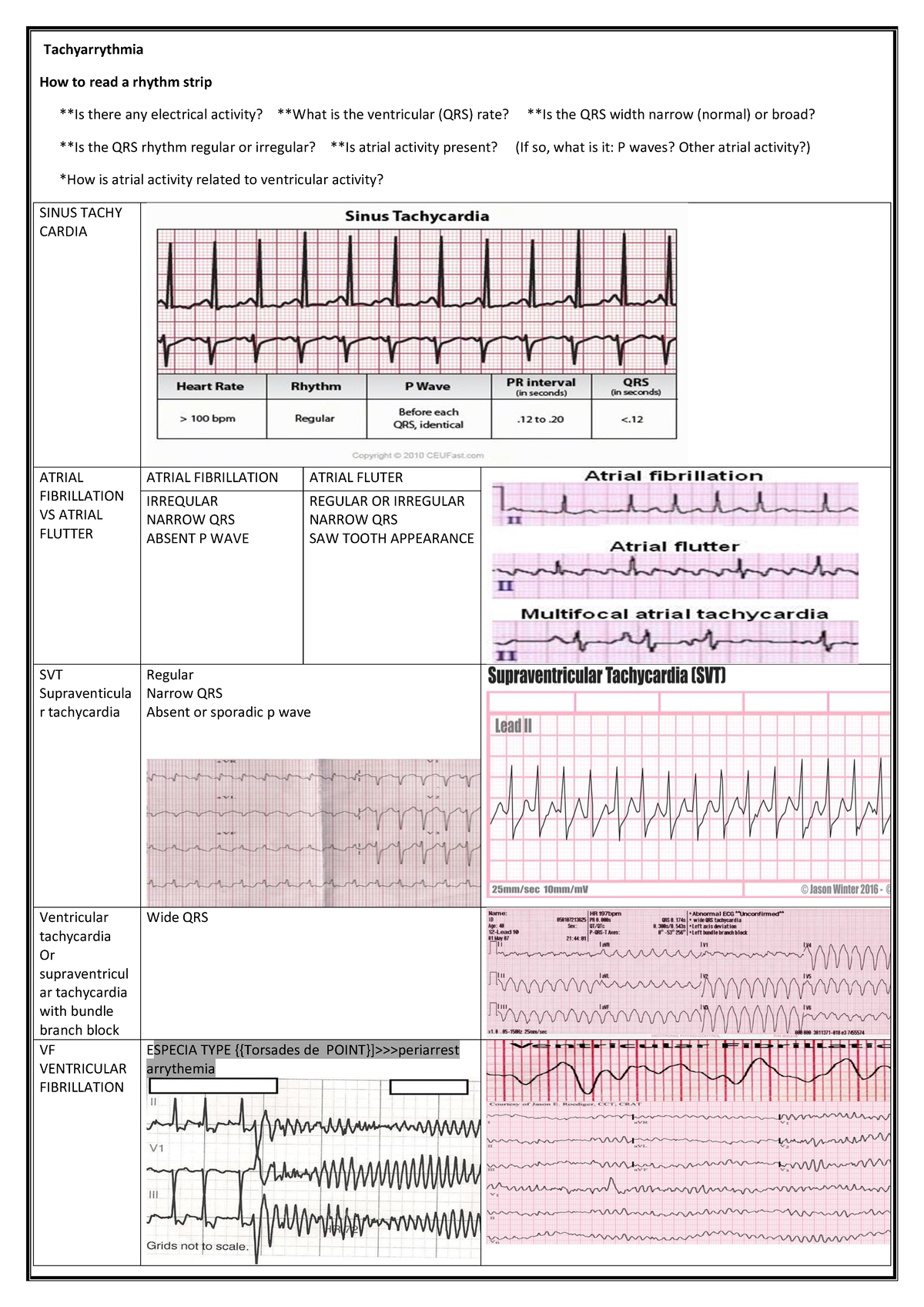 Tachyarrythmia - Tachyarrythmia How to read a rhythm strip **Is there ...