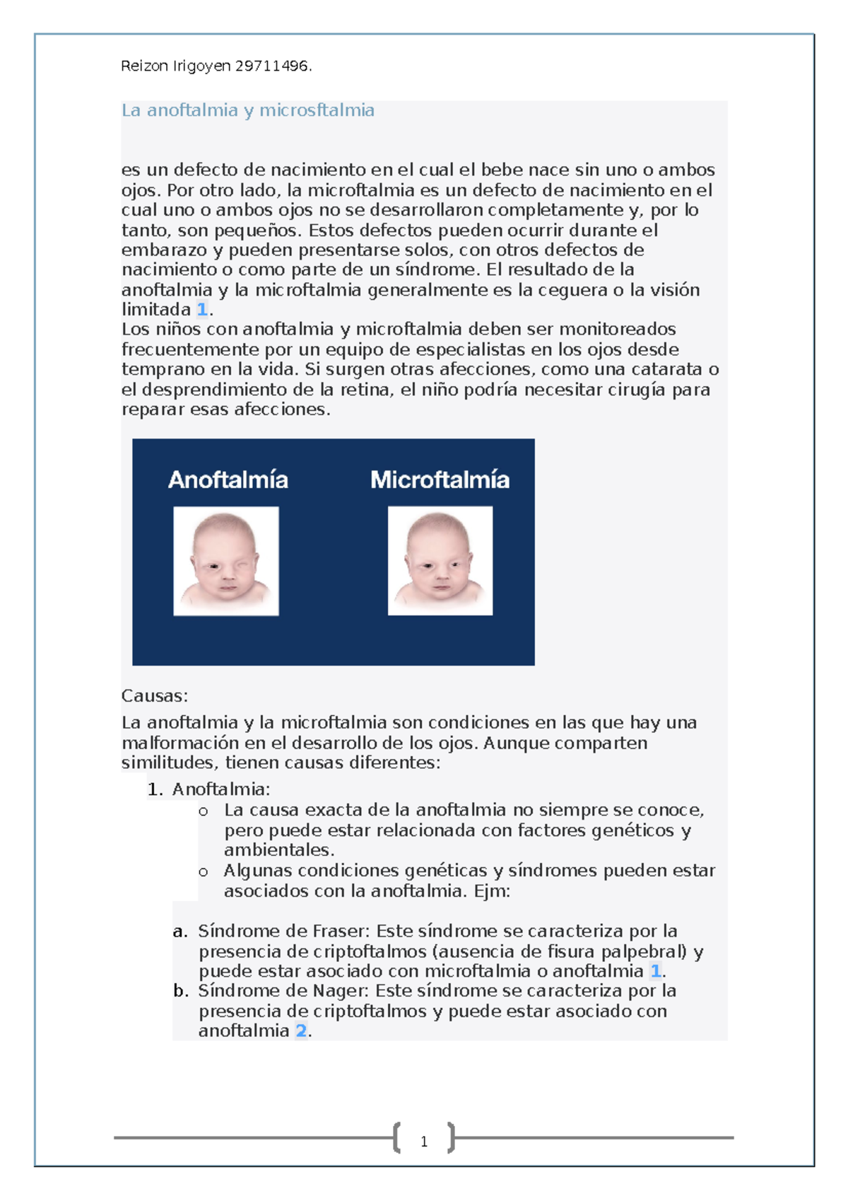 La anoftalmia es un defecto de nacimiento en el cual el beb nace sin ...