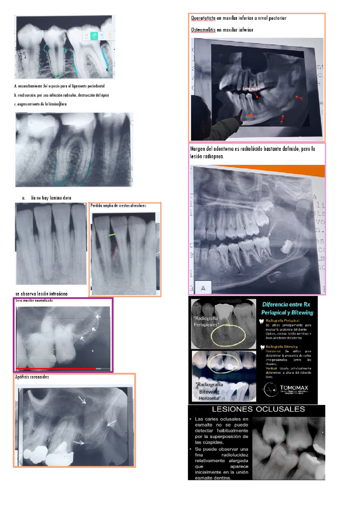 Rx imagenes - Queratotiste en maxilar inferior a nivel posterior ...