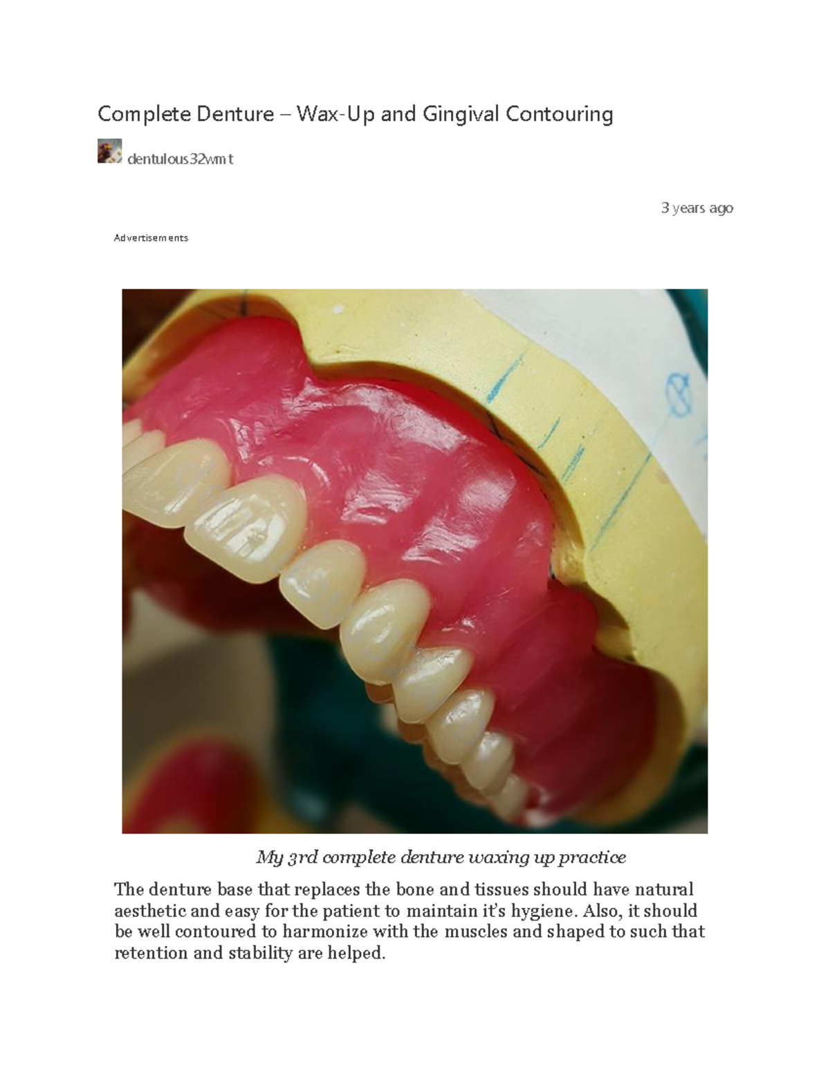 Complete Dendures Waxing UP - Complete Denture – Wax-Up and Gingival ...