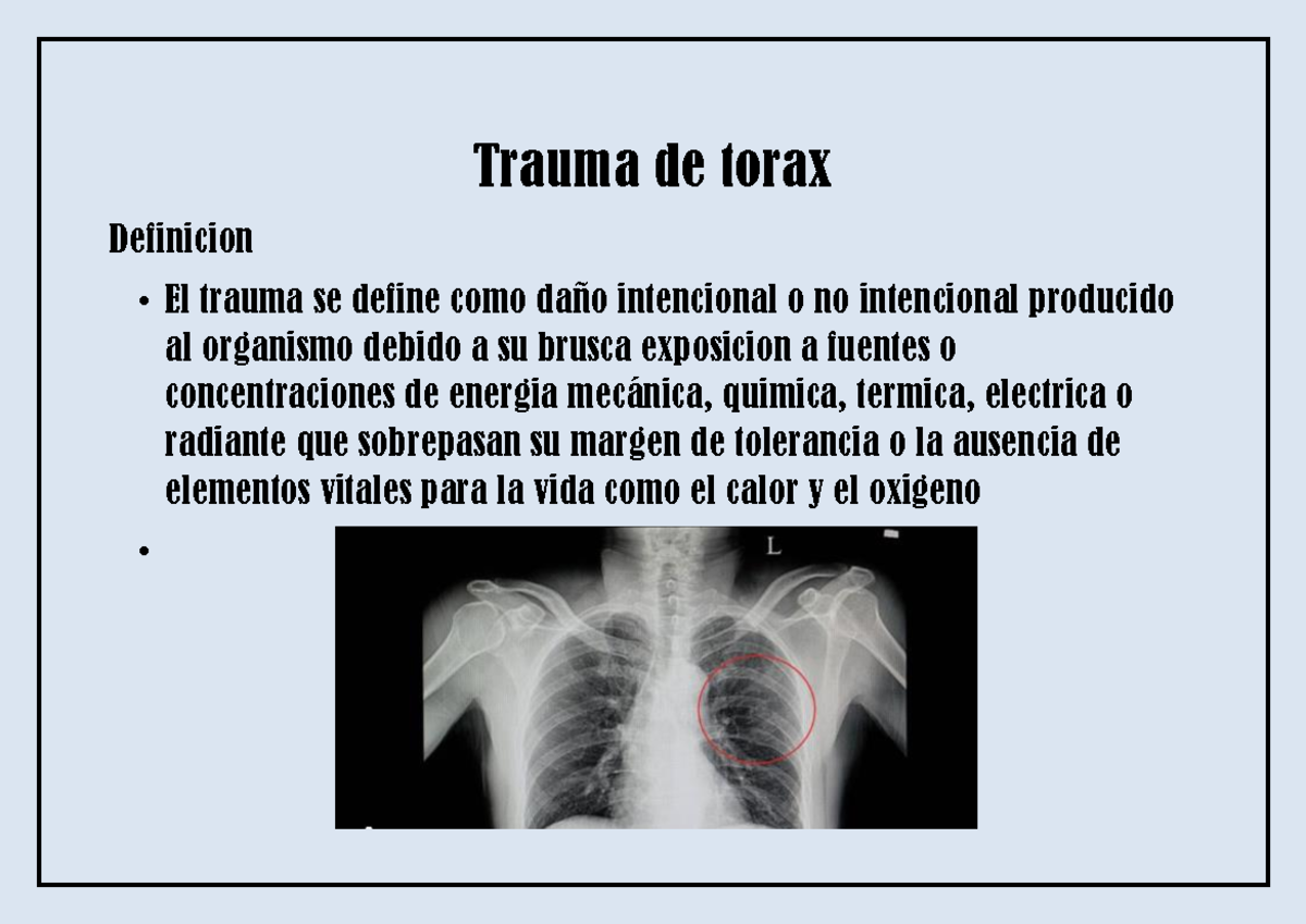 Trauma de torax - Trauma de torax Definicion • El trauma se define como ...