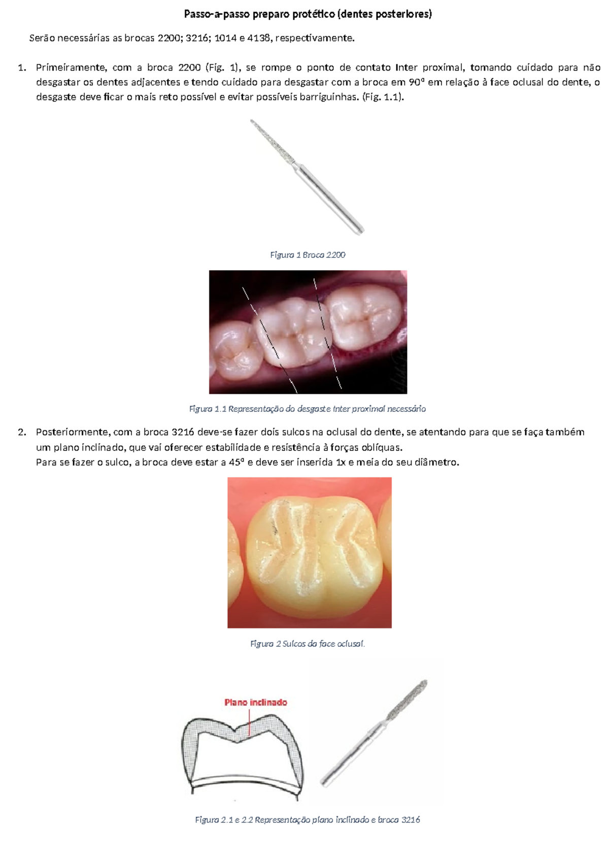Passo-a-passo preparo protético dente posterior - Passo-a-passo preparo ...