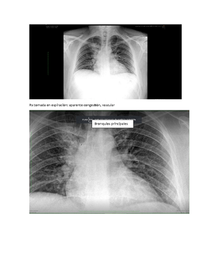 Clase Anatomía radiológica de tórax - La tráquea a nivel de la carina ...